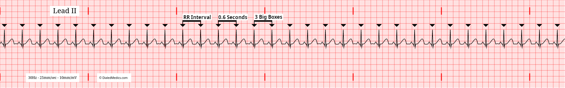The Normal Sinus Rhythm (NSR) ECG/EKG