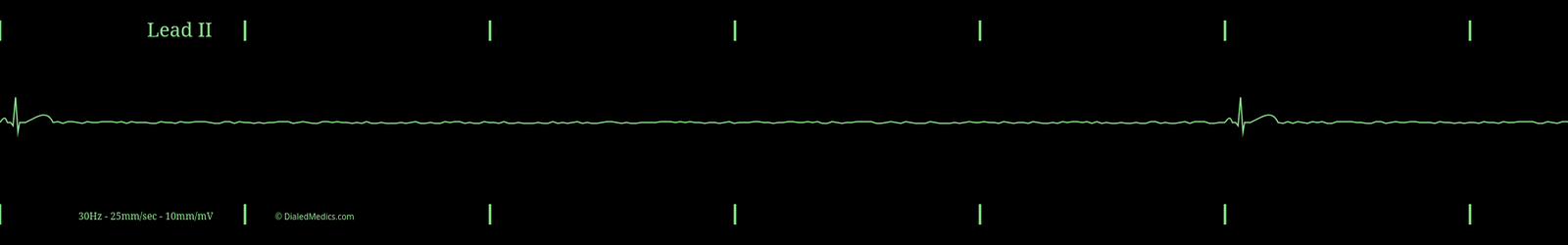 The Sinus Bradycardia ECG/EKG