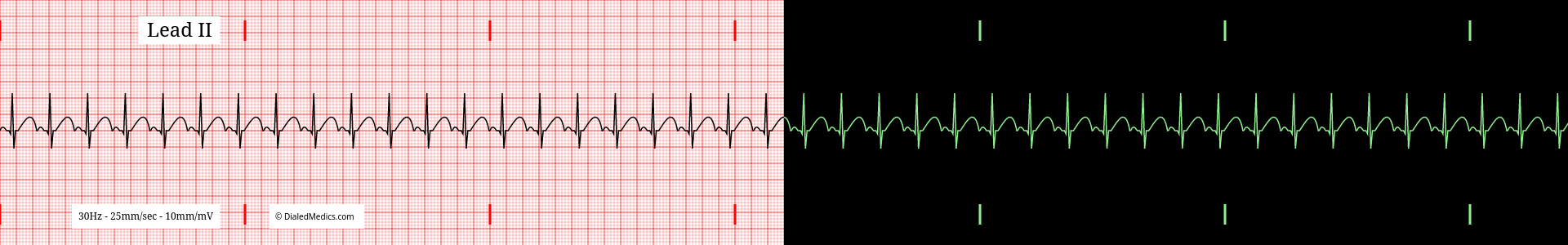 The Sinus Tachycardia ECG/EKG