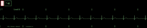 The Sinus Bradycardia EKG/ECG