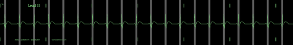 The Normal Sinus Rhythm (NSR) EKG/ECG