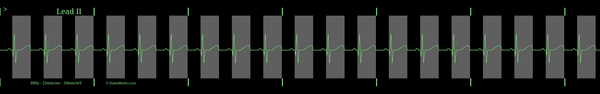 The Normal Sinus Rhythm (NSR) EKG/ECG