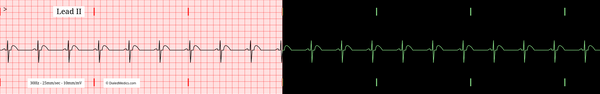 The Normal Sinus Rhythm (NSR) EKG/ECG