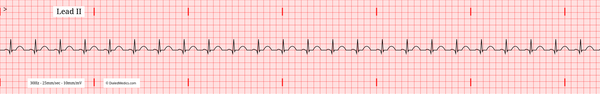 The Normal Sinus Rhythm (NSR) EKG/ECG