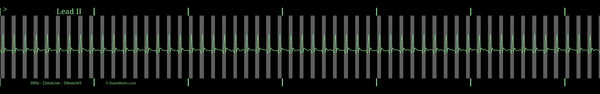 The Supraventricular Tachycardia (SVT) ECG/EKG