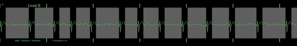 The Atrial Fibrillation (AF) ECG/EKG