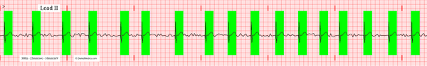 The Atrial Fibrillation (AF) ECG/EKG