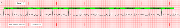 The Atrial Fibrillation (AF) ECG/EKG