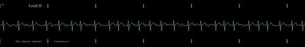 The Atrial Fibrillation (AF) ECG/EKG