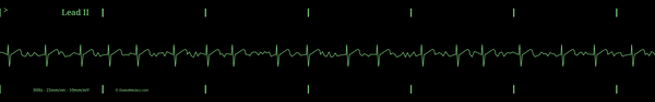 The Atrial Fibrillation (AF) ECG/EKG