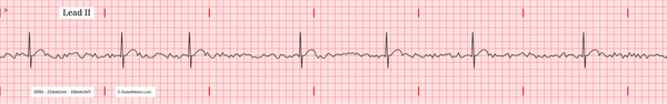 The Atrial Fibrillation (AF) ECG/EKG