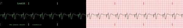 The Atrio-Ventricular Pacemaker EKG/ECG