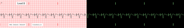 The Atrio-Ventricular Pacemaker EKG/ECG