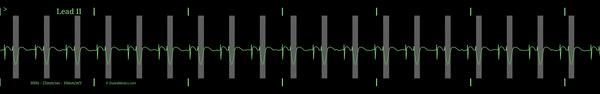The Atrio-Ventricular Pacemaker EKG/ECG