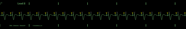 The Atrio-Ventricular Pacemaker EKG/ECG