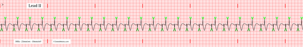 The Atrio-Ventricular Pacemaker EKG/ECG