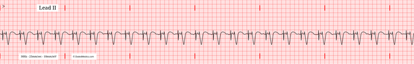 The Atrio-Ventricular Pacemaker EKG/ECG