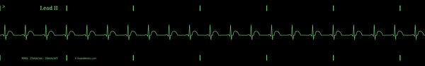 The Normal Sinus Rhythm (NSR) EKG/ECG