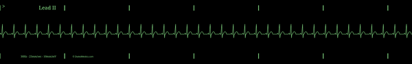 The Sinus Tachycardia EKG/ECG
