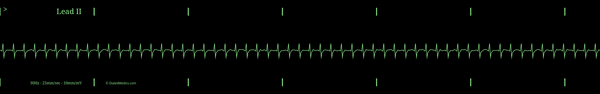 The Supraventricular Tachycardia (SVT) ECG/EKG