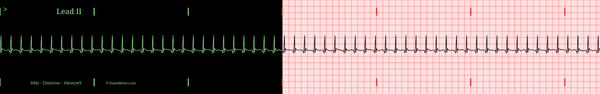 The Supraventricular Tachycardia (SVT) ECG/EKG