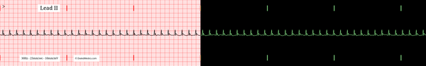 The Supraventricular Tachycardia (SVT) ECG/EKG