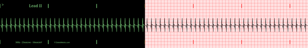 The Supraventricular Tachycardia (SVT) ECG/EKG