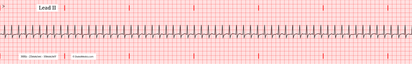 The Supraventricular Tachycardia (SVT) ECG/EKG