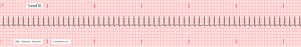 The Supraventricular Tachycardia (SVT) ECG/EKG