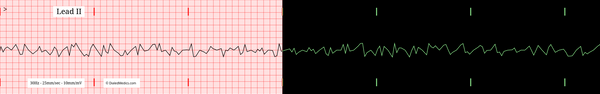 The Ventricular Fibrillation (VF) ECG/EKG
