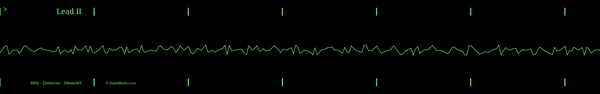 The Ventricular Fibrillation (VF) ECG/EKG