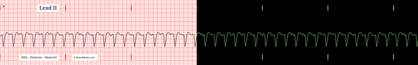 The Ventricular Tachycardia ECG/EKG