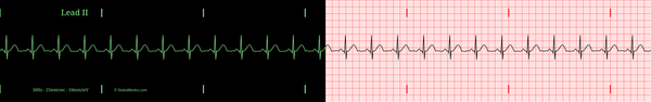 The Normal Sinus Rhythm (NSR) ECG/EKG