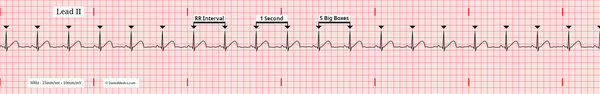 The Normal Sinus Rhythm (NSR) ECG/EKG