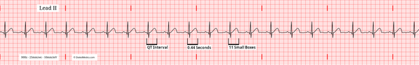 The Normal Sinus Rhythm (NSR) ECG/EKG