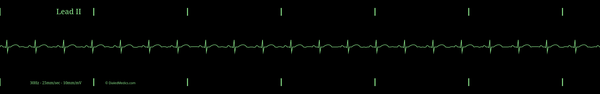 The Normal Sinus Rhythm (NSR) ECG/EKG
