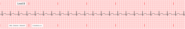 The Normal Sinus Rhythm (NSR) ECG/EKG