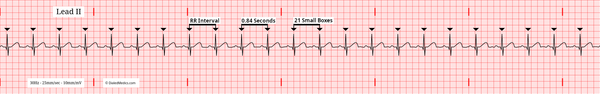 The Normal Sinus Rhythm (NSR) ECG/EKG