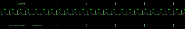 The Normal Sinus Rhythm (NSR) ECG/EKG