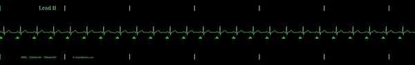 The Normal Sinus Rhythm (NSR) ECG/EKG