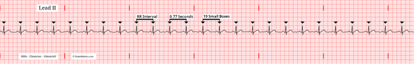 The Normal Sinus Rhythm (NSR) ECG/EKG