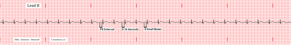 The Normal Sinus Rhythm (NSR) ECG/EKG