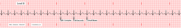 The Normal Sinus Rhythm (NSR) ECG/EKG