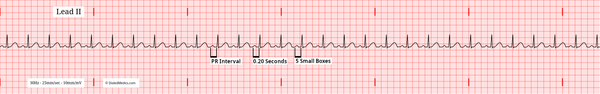 The Normal Sinus Rhythm (NSR) ECG/EKG