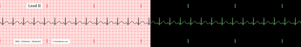 The Normal Sinus Rhythm (NSR) ECG/EKG
