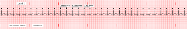 The Normal Sinus Rhythm (NSR) ECG/EKG
