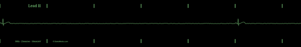 The Sinus Bradycardia ECG/EKG