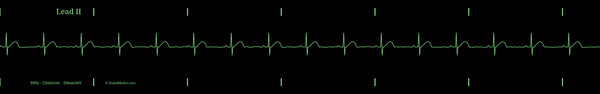 The Sinus Bradycardia ECG/EKG