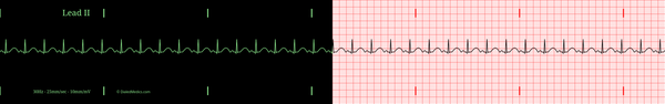 The Sinus Tachycardia ECG/EKG