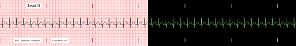 The Sinus Tachycardia ECG/EKG